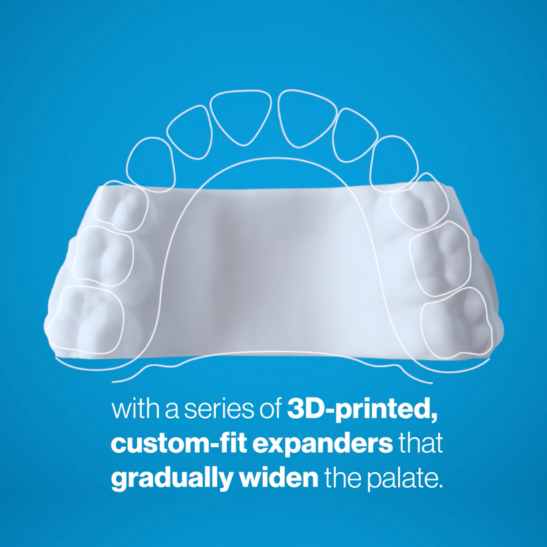 Invisalign Palatal Expander | Goodman orthodontics