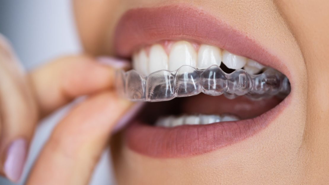 The Invisalign align technology: A precision orthodontic method ...