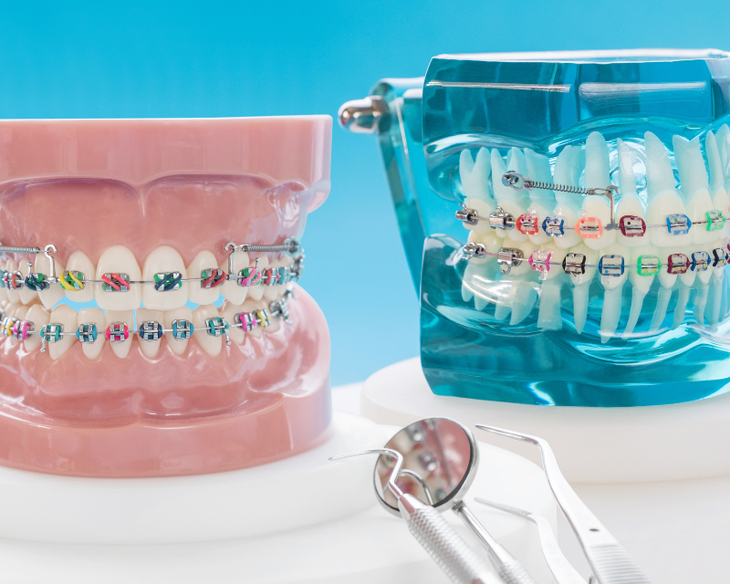 The Ultimate Braces Bracket Showdown: Metal vs. Ceramic - Goodman ...