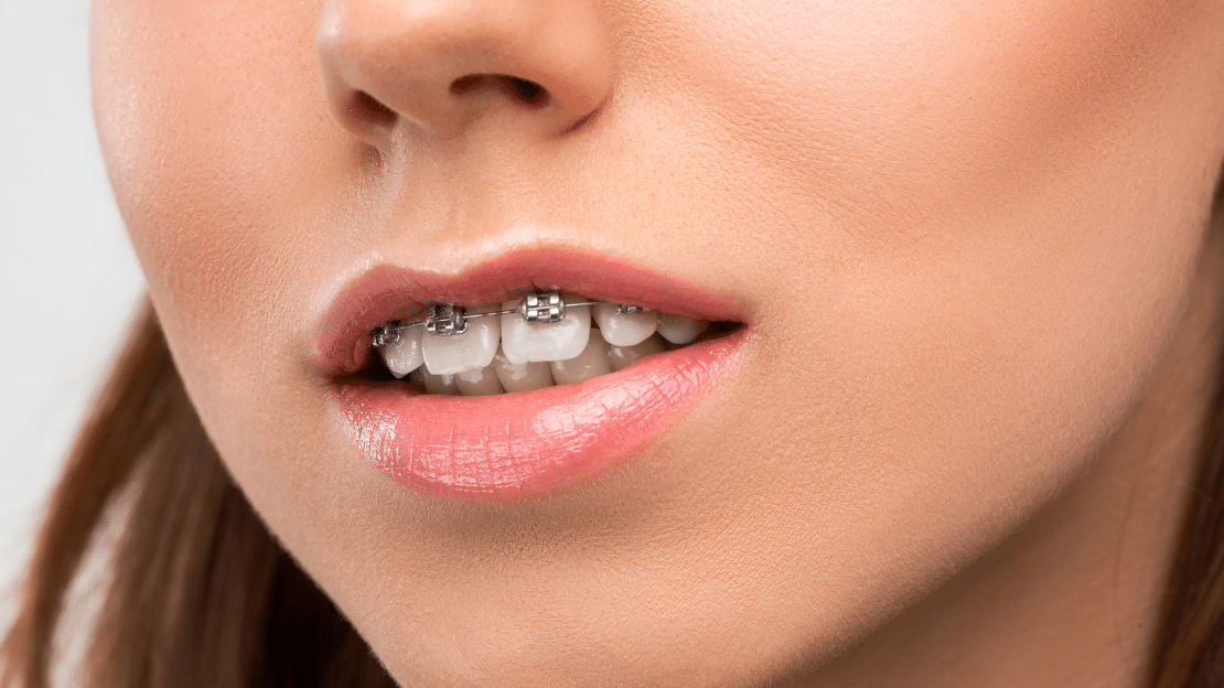 Do Braces Change Your Face Shape? Orthodontic Impacts on Facial ...